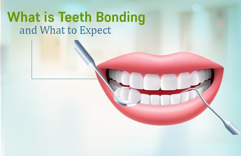 What is Teeth Bonding? Benefits & Procedure Details