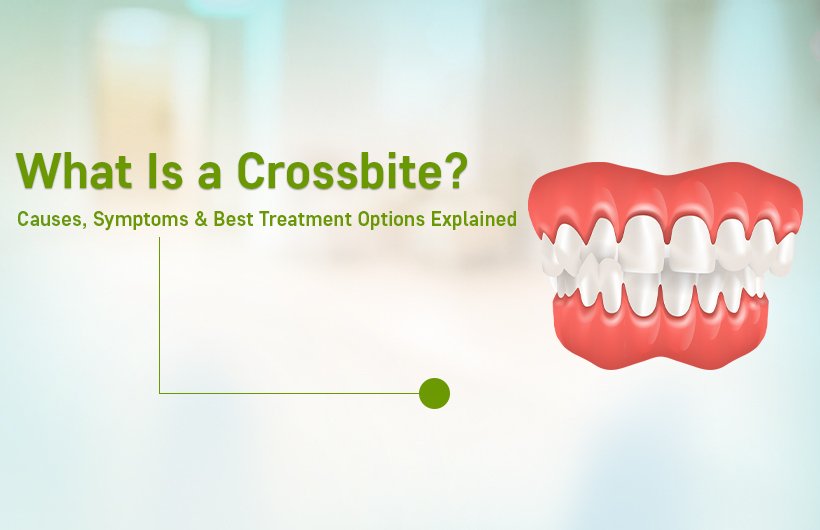 What Is Crossbite? Causes, Symptoms & Cure